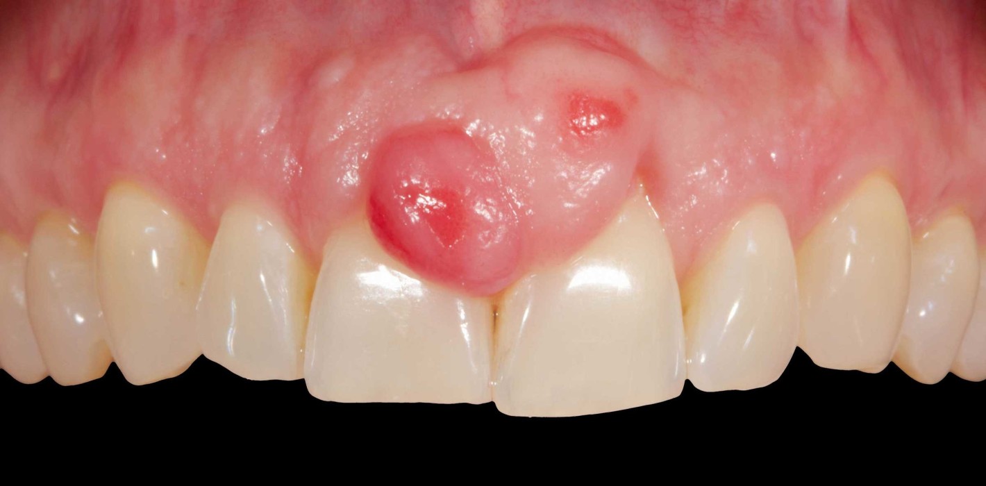 Epulis Granulomatosa